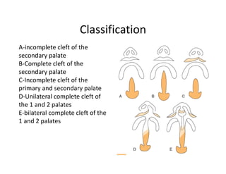 Cleft lip and palate | PDF
