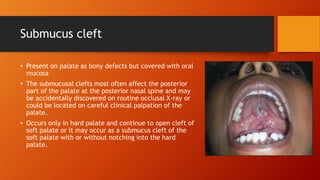Cleft lip and palate and its management | PPT