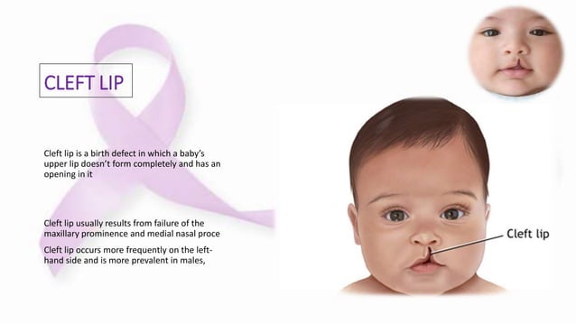 cleft lip and palate awareness.pptx