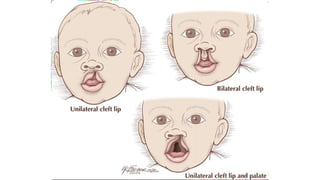 CLEFT LIP AND PALATE ETIOLOGY AND CLASSIFICATION.pptx