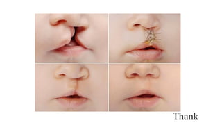 CLEFT LIP AND PALATE ETIOLOGY AND CLASSIFICATION.pptx