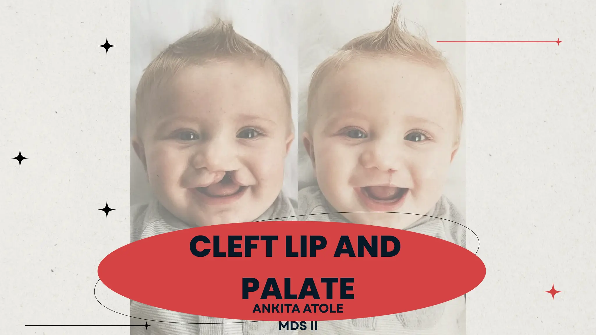 Cleft Lip and Palate: From Diagnosis to Multidisciplinary Management | PDF