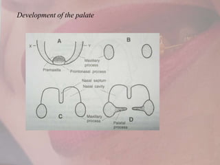 Cleft lip and palate O.ppt
