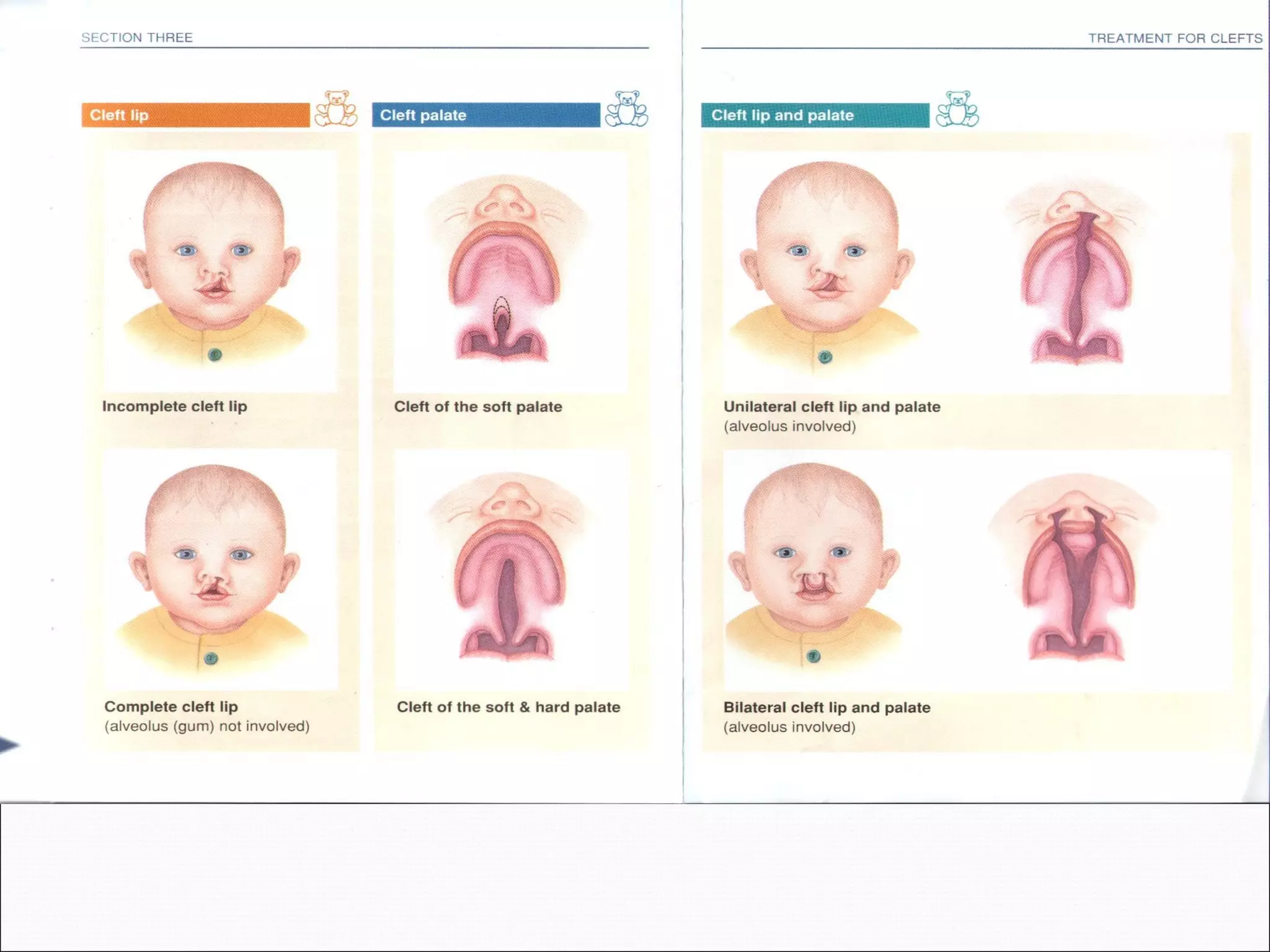 Cleft lip and palate ppt | PPT