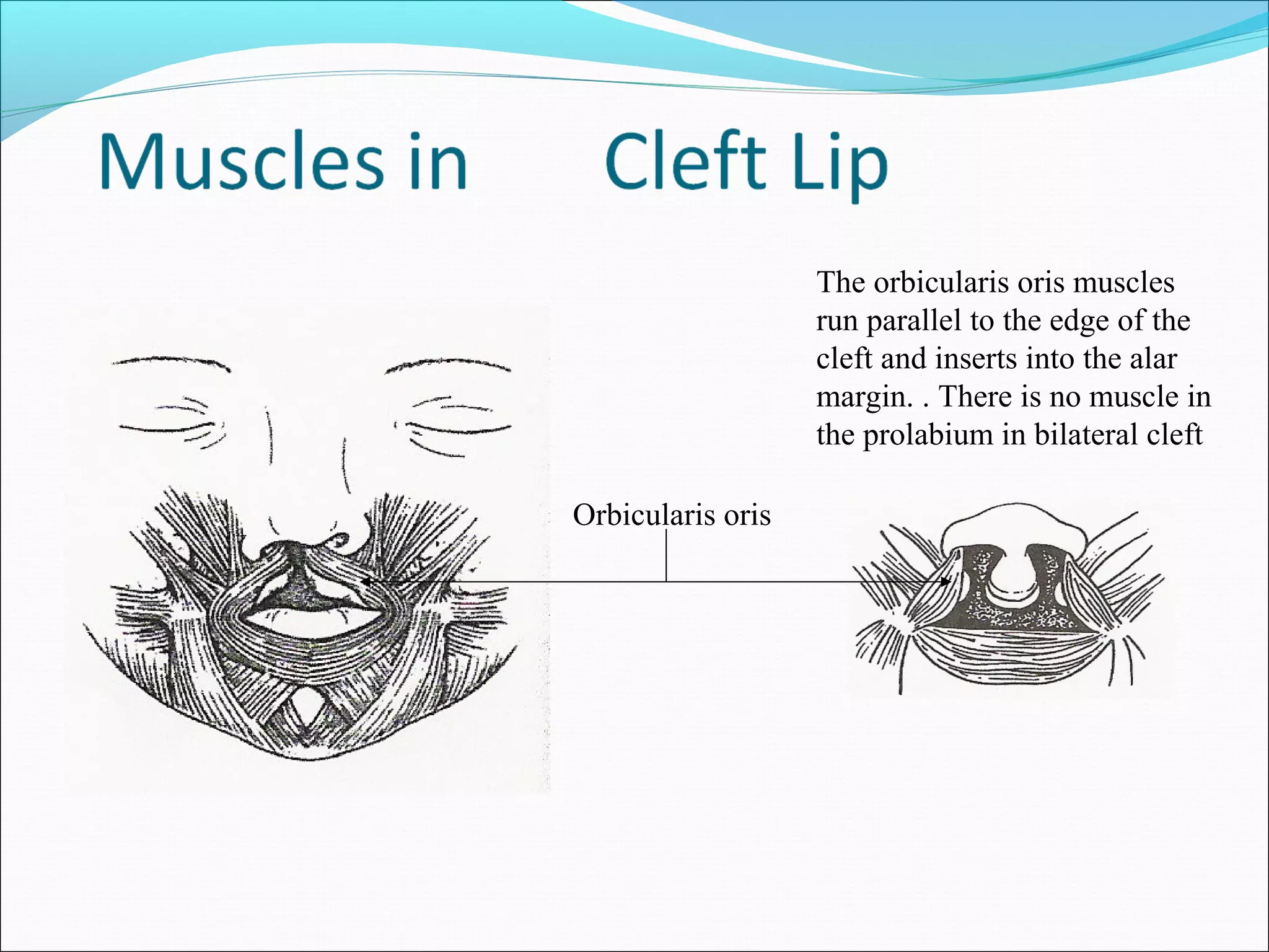 Cleft lip and palate ppt | PPT