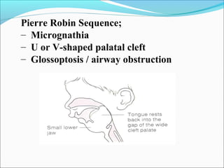 Cleft lip and palate ppt | PPT