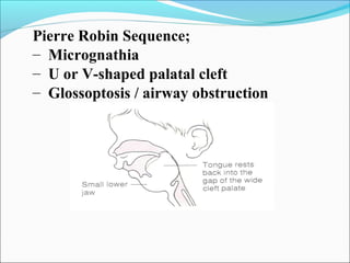 Cleft lip and palate ppt | PPT