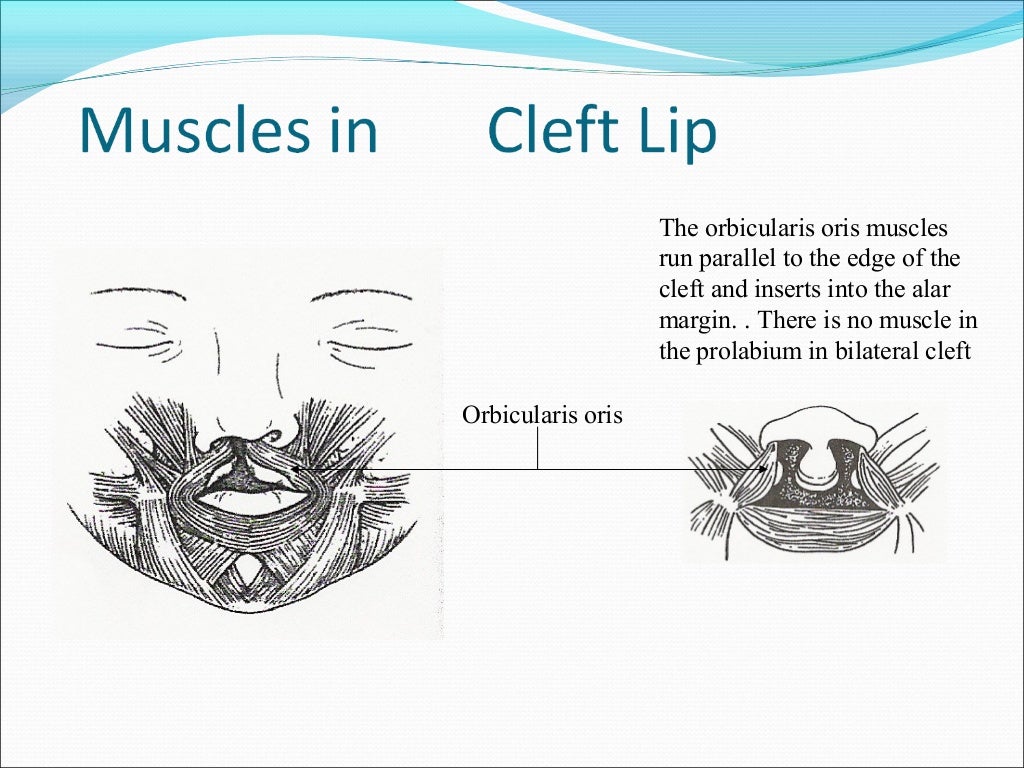 Cleft Lip And Palate Ppt