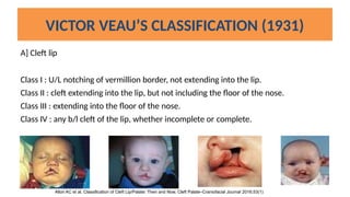 Management of CLEFT LIP AND PALATE SEMINAR | PPTX