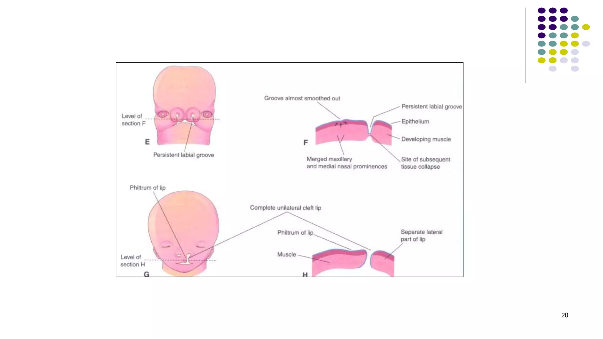 Cleft lip and palate slideshare | PPTX