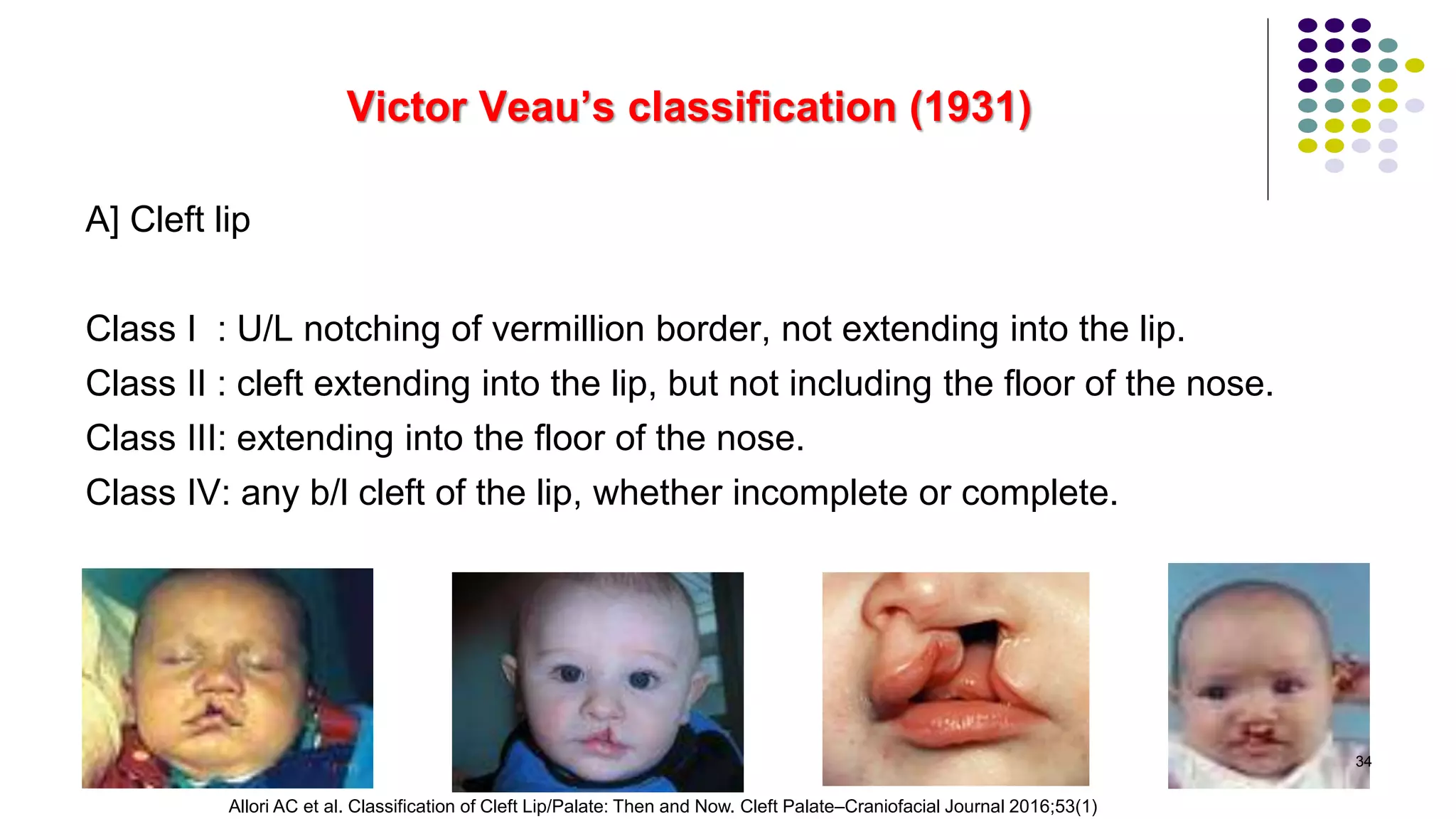 Cleft lip and palate slideshare | PPTX