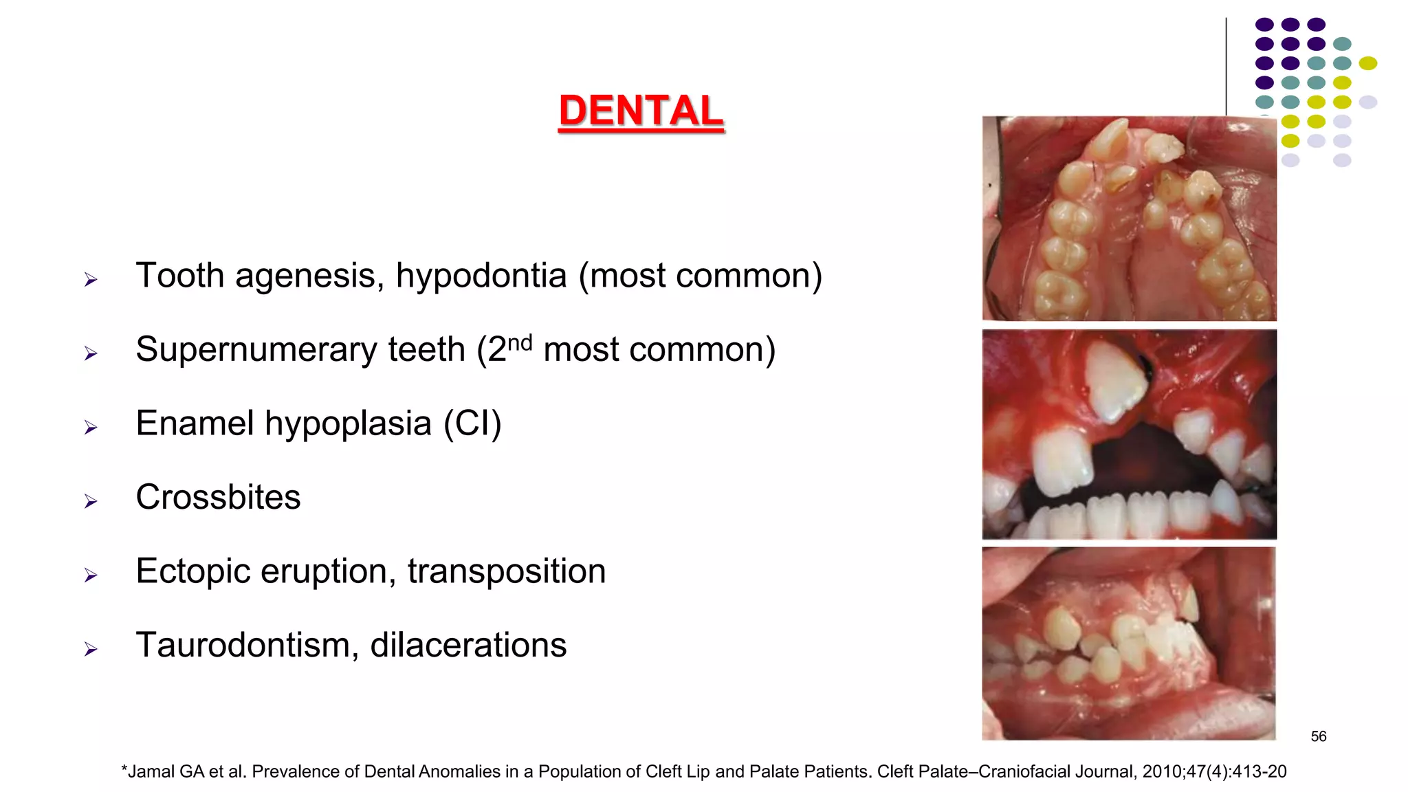 Cleft lip and palate slideshare | PPTX
