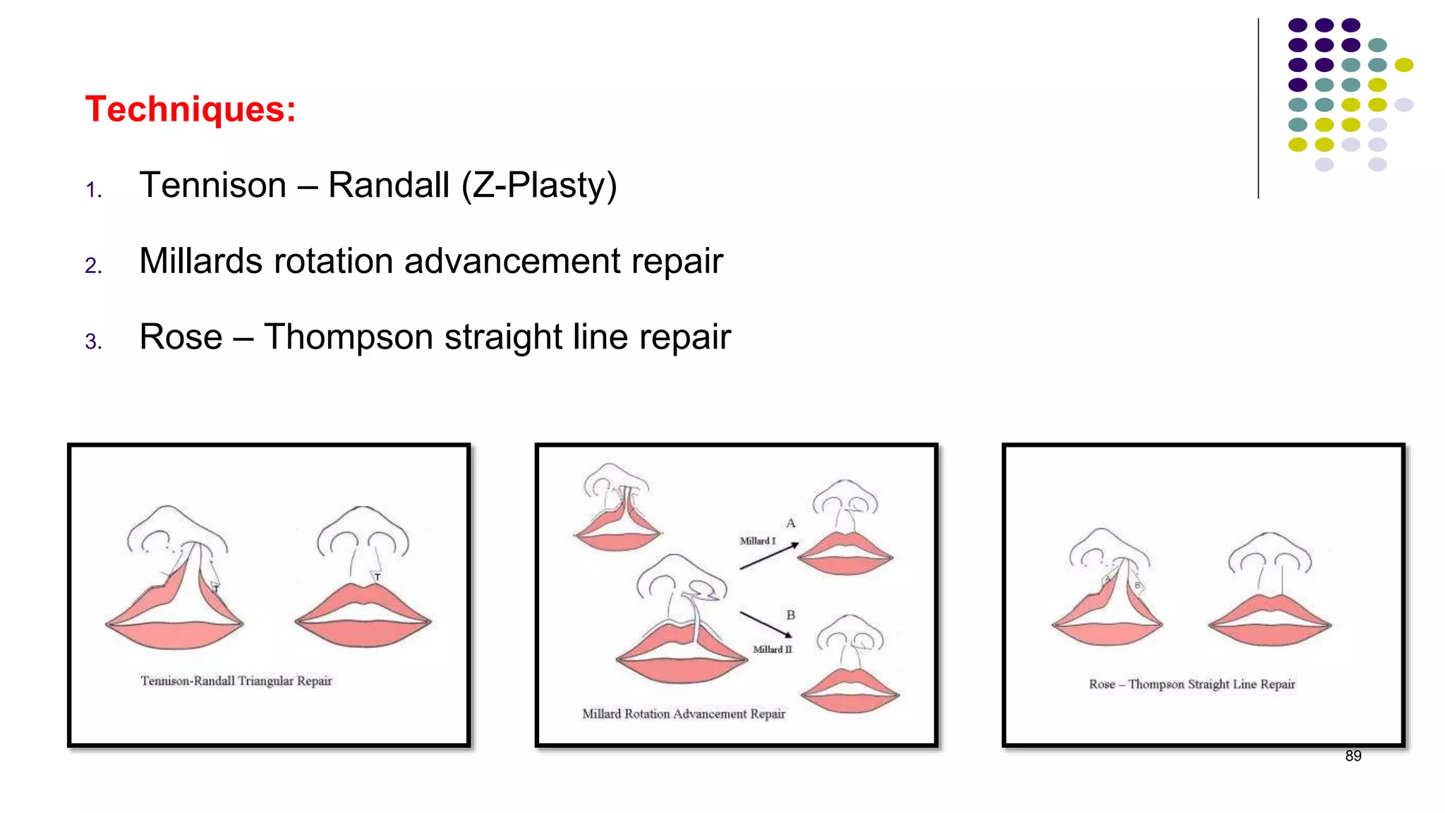 Cleft lip and palate slideshare | PPTX