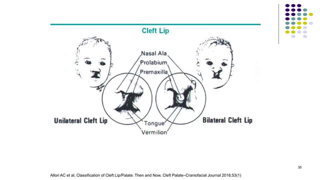 Cleft lip and palate slideshare | PPTX | Ear, Nose and Throat ...