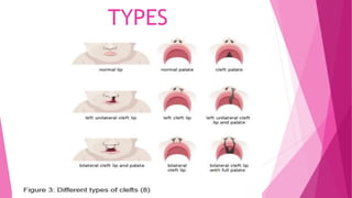 Cleft lip and palatre | PPTX