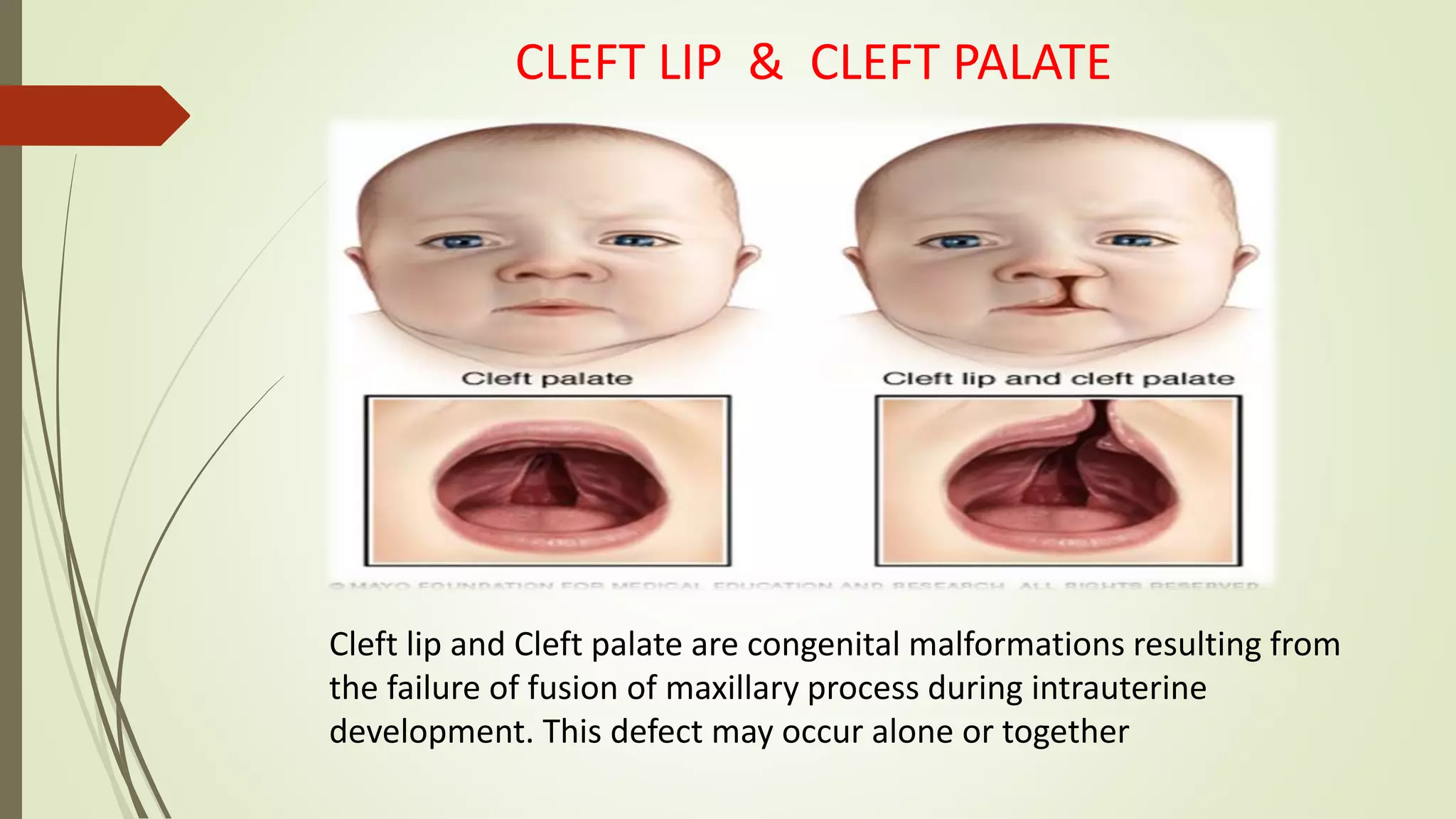 Cleft lip and cleft palate | PPTX
