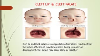 Cleft lip and cleft palate | PPTX