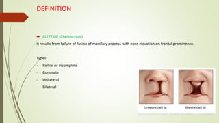 Cleft lip and cleft palate | PPTX