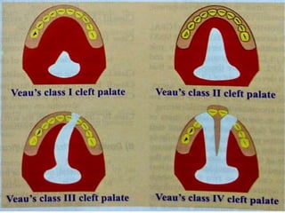 Cleft lip & cleft palate | PPTX