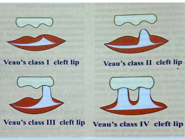 Cleft lip & cleft palate