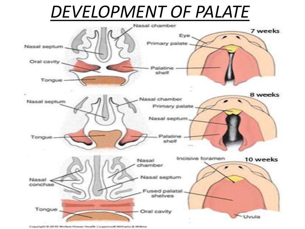 Cleft Lip And Cleft Palate