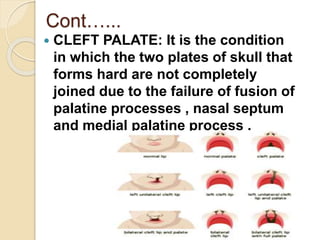 Cleft lip cleft palate | PPTX