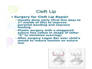 CLEFT LIP & CLEFT PALATE / paediatric .. | PPTX