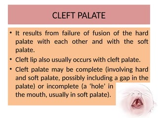 CLEFT LIP & CLEFT PALATE / paediatric .. | PPTX