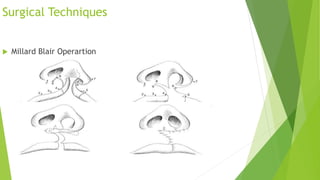 Cleft lip, Cleft palate & Spina bifida | PPTX