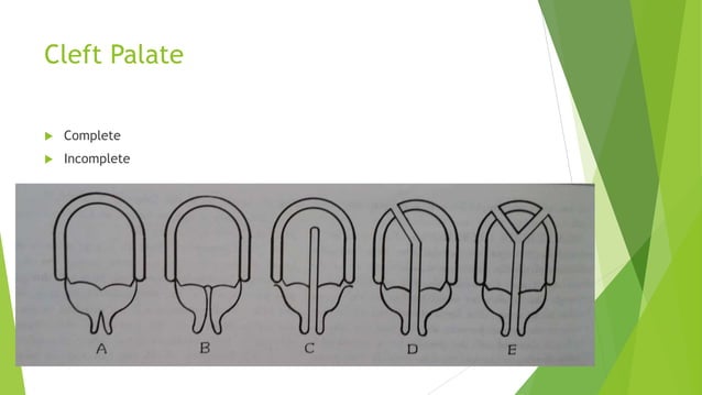 Cleft lip, Cleft palate & Spina bifida | PPTX