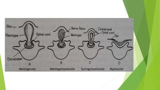 Cleft lip, Cleft palate & Spina bifida | PPTX