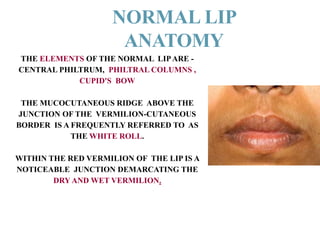 cleft lip FINAL.ppt