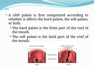 cleft lip n.pptx genetic disorders cleft lip | PPTX