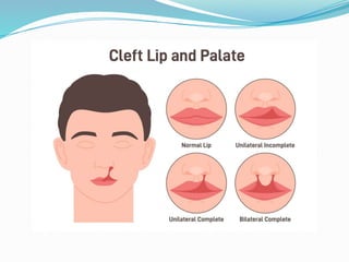 cleft lip n.pptx genetic disorders cleft lip | PPT