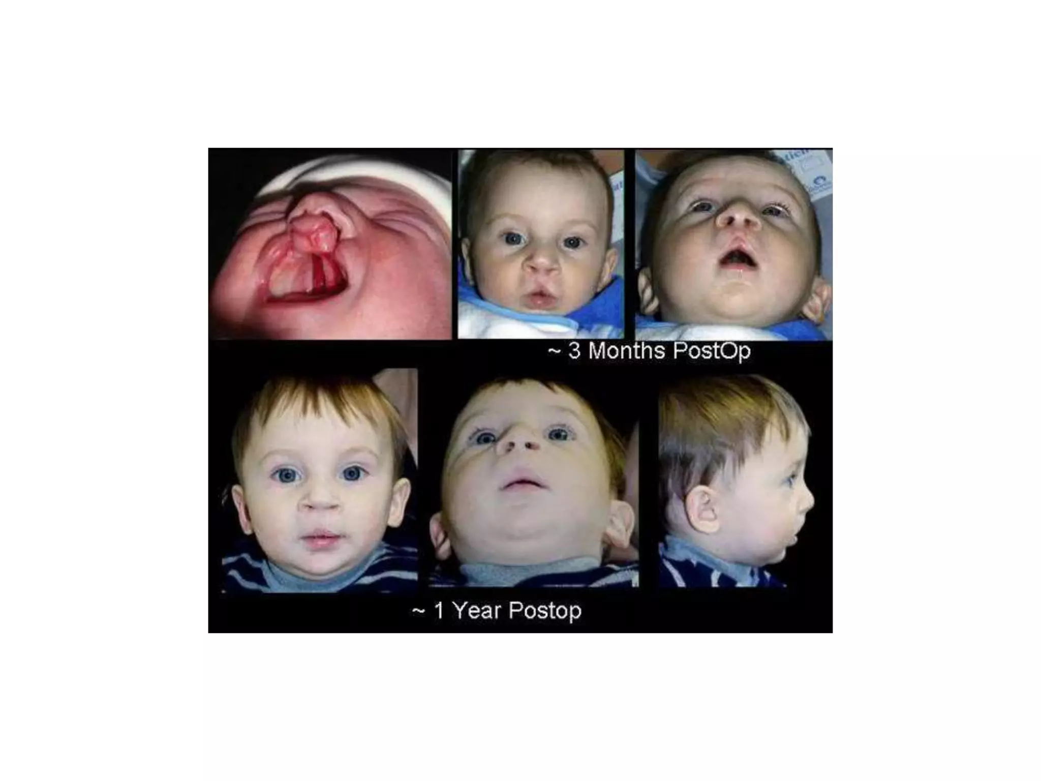cleft lip n palate.pptx | Ear, Nose and Throat Conditions | Diseases and Conditions