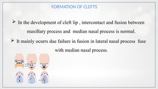 cleft lip and its management protocols.pptx