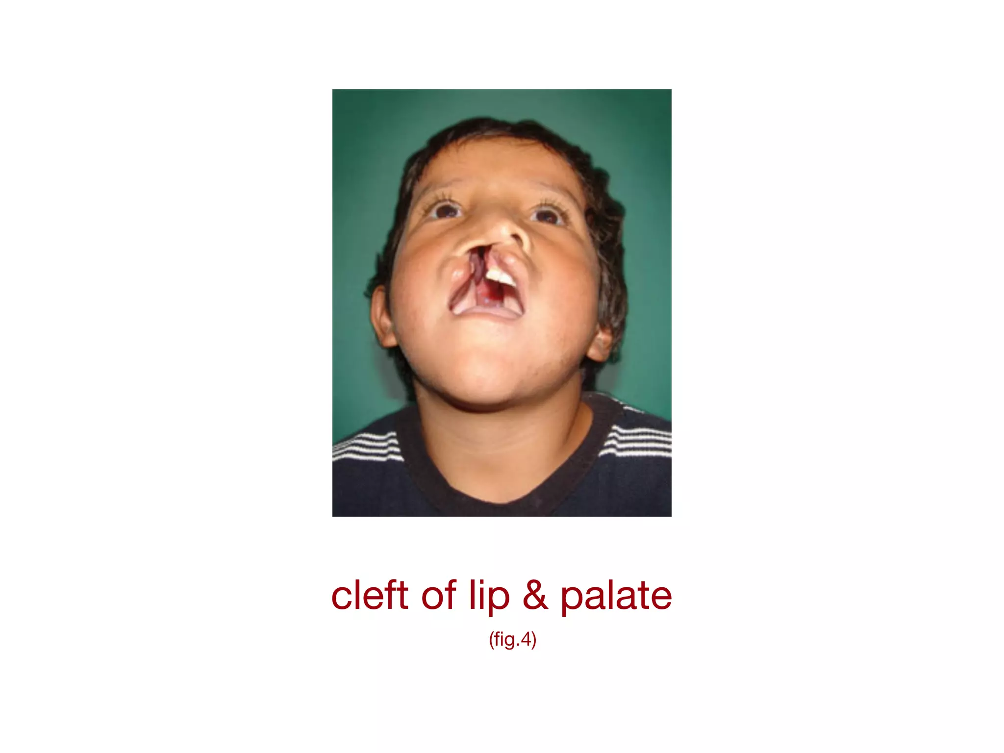 Cleft lip & Cleft palate | PDF