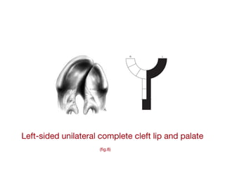 Cleft lip & Cleft palate | PDF