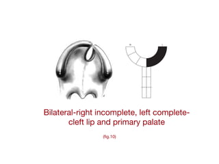 Cleft lip & Cleft palate | PDF