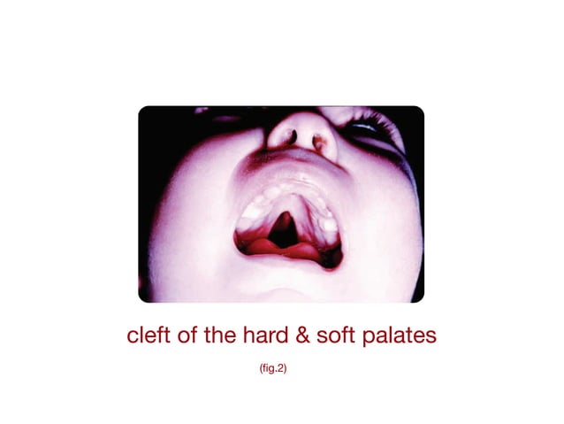 Cleft lip & Cleft palate | PDF
