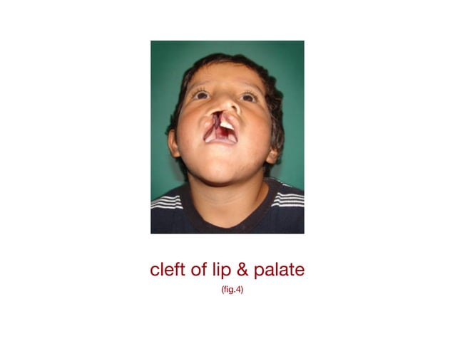 Cleft lip & Cleft palate | PDF