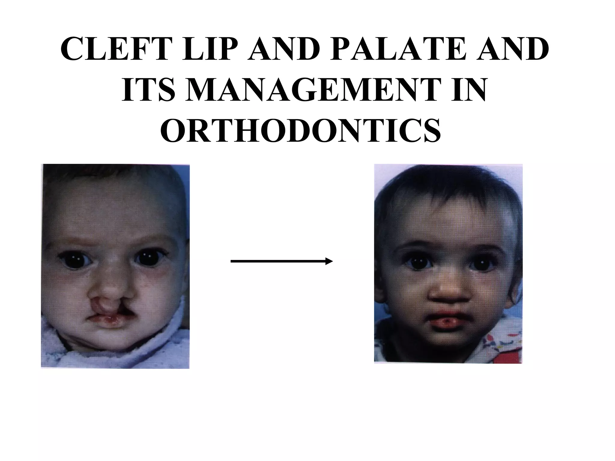 Cleft lip & palate management in orthodontics | PPT
