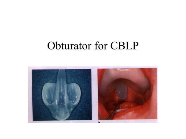 Cleft lip & palate management in orthodontics | PPT