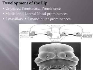 Cleft lip and palate | PPTX