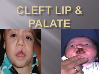 Cleft lip and palate | PPT