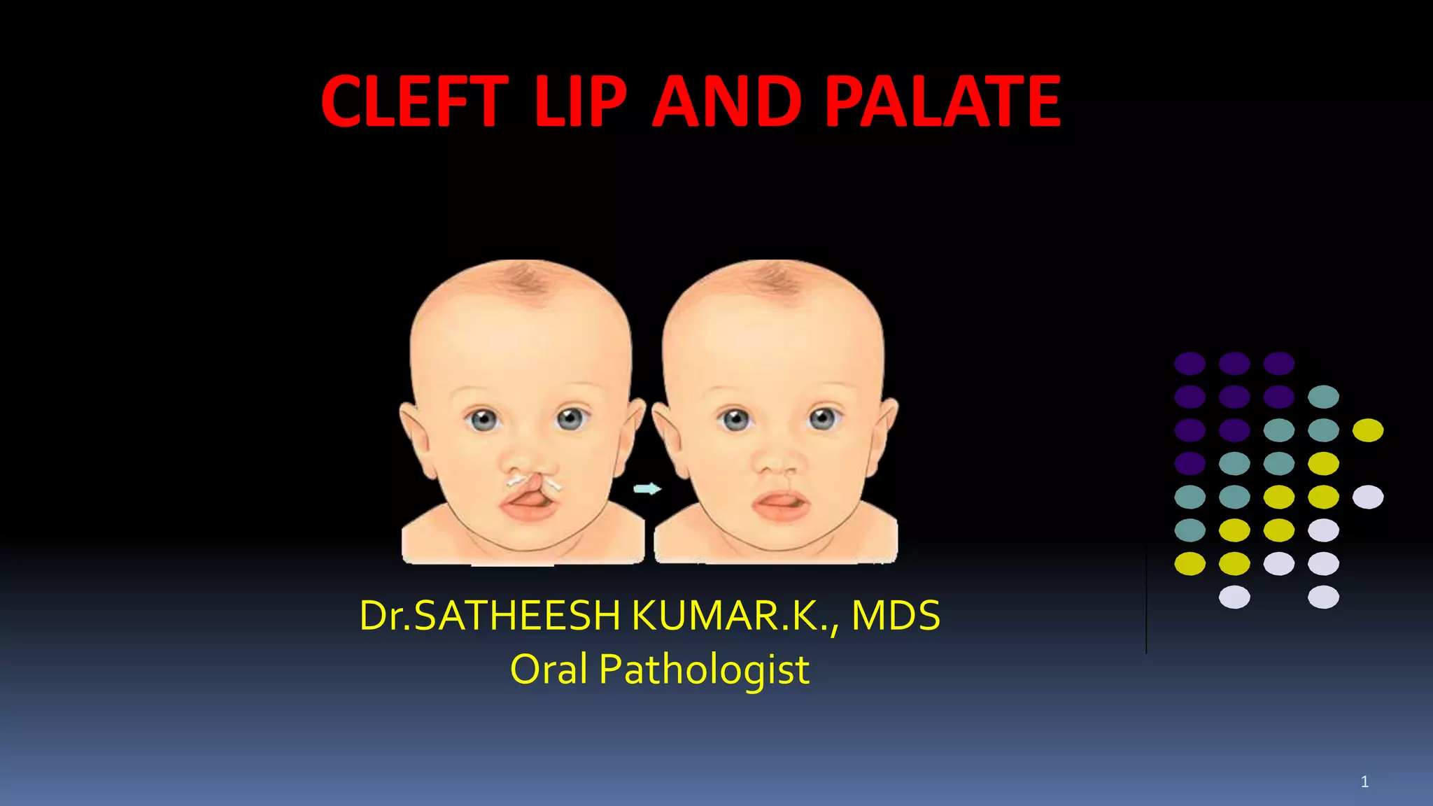 CLEFT LIP & PALATE | PPT
