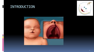 CLEFT LIP & PALATE | PPT