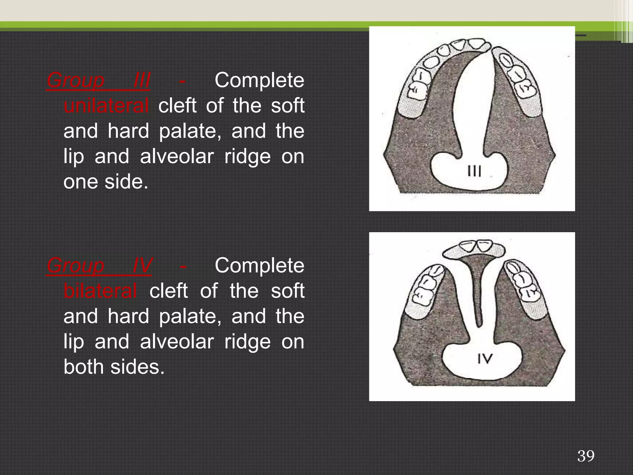 Cleft lip palate | PPT