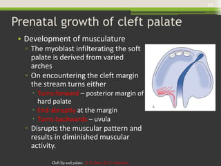Cleft lip palate | PPTX