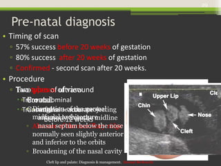 Cleft lip palate | PPTX